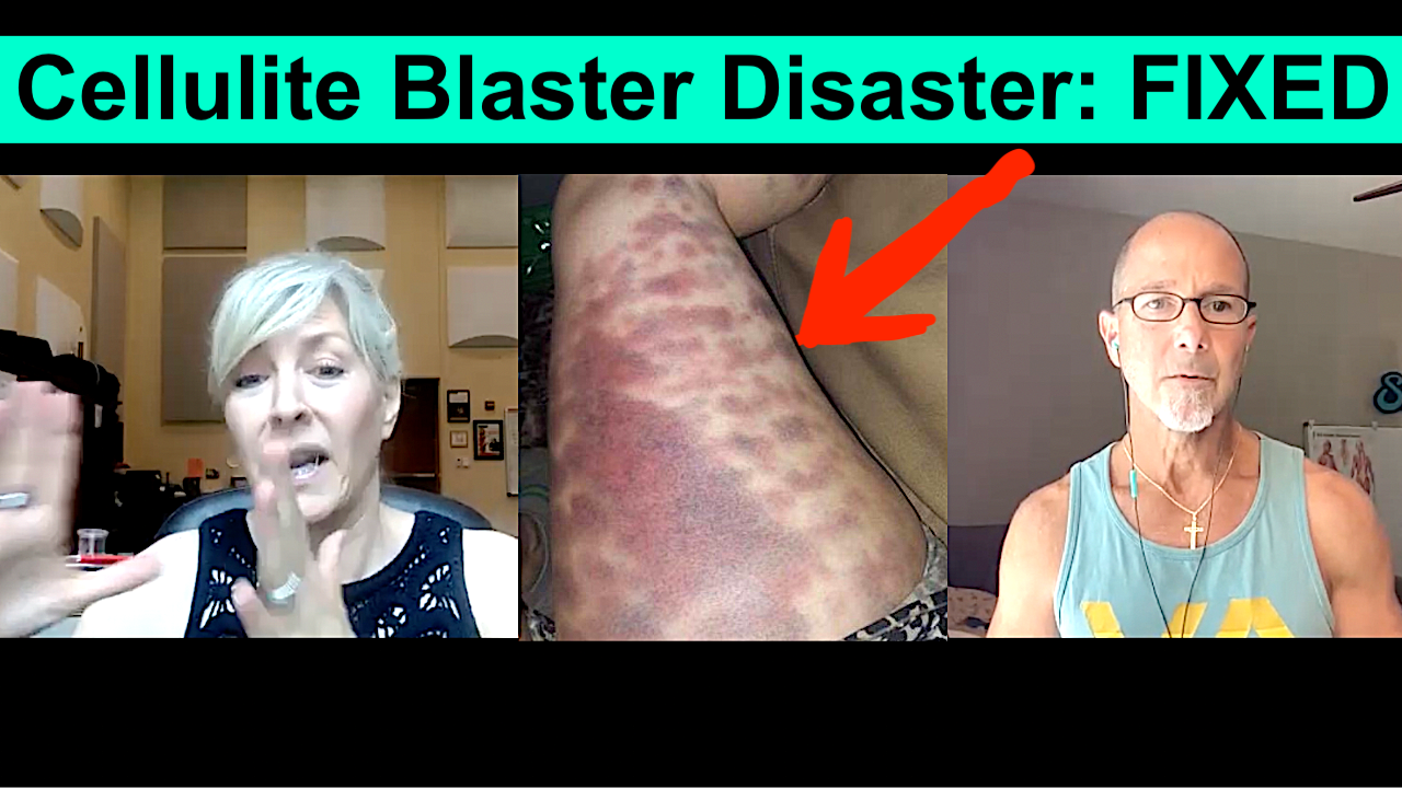 Cellulite Gone After Blasting Fascia Makes it Worse with Cellulite ...